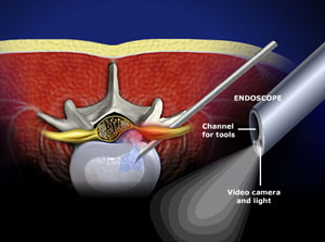 Lumbar Discoscopic Discectomy