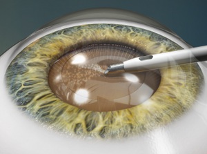 Refractive Lens Exchange (Clear Lens Exchange)