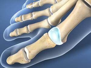 Metatarsal Head Resurfacing with Collagen Interpositional Grafting ...