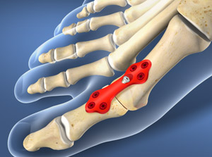 First MTP Joint Fusion (Locking Plate) - Willis Knighton Health ...