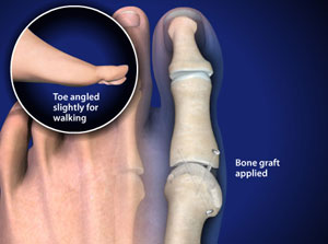 First Metatarsal-phalangeal Joint (MTP) Arthrodesis