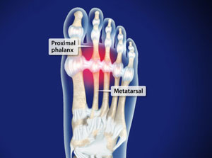 MTP Synovitis (Capsulitis) - Willis Knighton Health - Shreveport ...