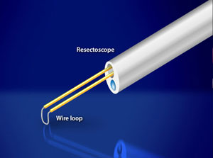 Myomectomy (Hysteroscopic Resectoscope) - Willis Knighton Health ...