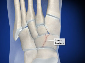 Navicular Stress Fracture - Willis Knighton Health - Shreveport ...