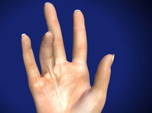 Needle Aponeurotomy for Dupuytren's Contracture - Willis Knighton ...