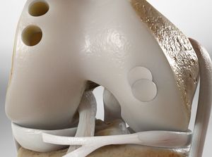 Osteoarticular Transfer System (OATS) - Willis Knighton Health ...