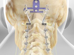 Occipito-Cervical Fixation (OC Fusion)