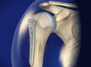 ORIF Surgery for Proximal Humerus Fracture