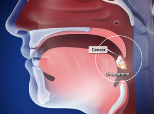 Oropharyngeal Cancer The Combined HPV16 E2/E6/E7 T Cell Response In