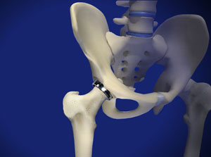 Hip Resurfacing - Willis Knighton Health - Shreveport - Bossier City ...