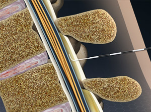 Patient-Controlled Epidural Analgesia (PCEA) - Willis Knighton Health ...