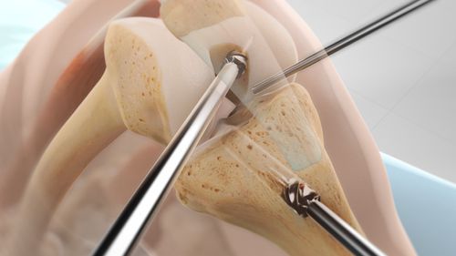 PCL Reconstruction (Posterior Cruciate Ligament Reconstruction ...