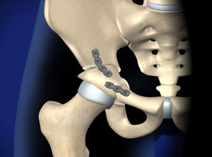 Periacetabular Osteotomy - Willis Knighton Health - Shreveport ...