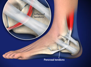 Peroneal Tendonitis - Willis Knighton Health - Shreveport - Bossier ...