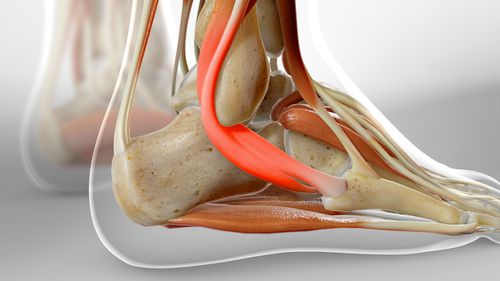 Peroneal Tendonitis (Peroneal Tendinitis) - Willis Knighton Health ...