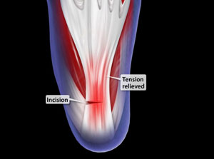 Plantar Fascia Release (Open Technique) - Willis Knighton Health ...