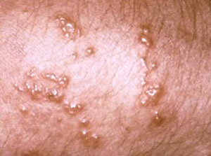 Poison Ivy/Oak/Sumac Reaction (Urushiol-Induced Contact Dermatitis)