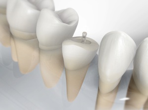 Post and Core Restoration (Prefabricated Post System) - Willis Knighton ...