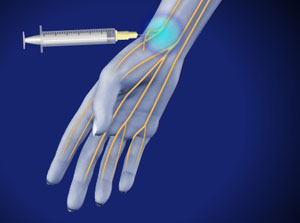 Radial Nerve Block - Willis Knighton Health - Shreveport - Bossier City ...