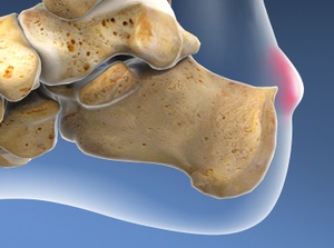 Haglund's Deformity Surgery (Resection Method) - Willis Knighton Health ...