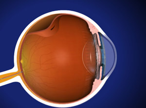 Pneumatic Retinopexy - Willis Knighton Health - Shreveport - Bossier ...