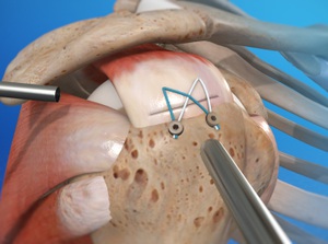 Mini-Open Rotator Cuff Repair - Willis Knighton Health - Shreveport - Bossier City - Ark-La-Tex