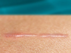 Scars - Willis Knighton Health - Shreveport - Bossier City - Ark-La-Tex