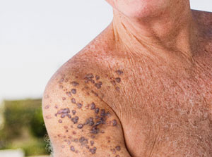 Seborrheic Keratosis - Willis Knighton Health - Shreveport - Bossier ...