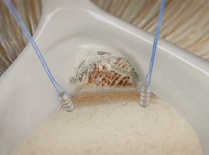 SLAP Tear Surgery (Arthroscopic Method) - Willis Knighton Health ...