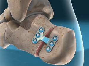 Calcaneal Sliding Osteotomy (with Lateral Plate Fixation)