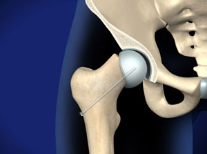 Internal Screw Fixation for Slipped Capital Femoral Epiphysis (SCFE)