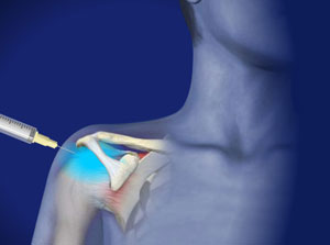 Soft Tissue Injection: Shoulder - Willis Knighton Health - Shreveport ...