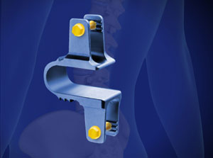 Interspinous Stabilization (Coflex)