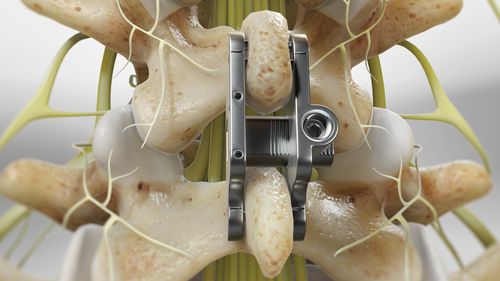 Spinous Process Plating - Willis Knighton Health - Shreveport - Bossier ...