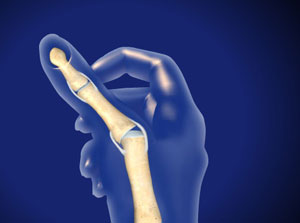 Thumb Ulnar Collateral Ligament (UCL) Injury