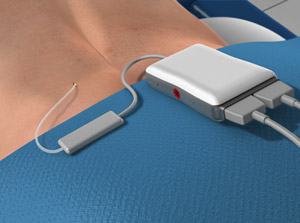 Spinal Cord Stimulator Implant