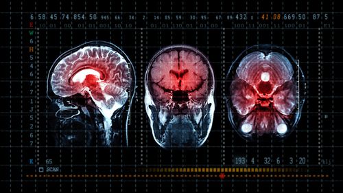 Subarachnoid Hemorrhage (SAH)