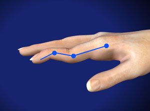 Swan Neck Deformity - Willis Knighton Health - Shreveport - Bossier ...