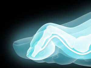 Tendon Transfer for Hammertoe (FDL tendon transfer) - Willis Knighton ...