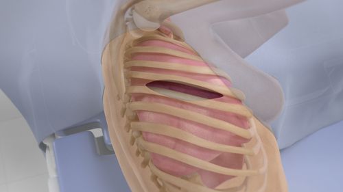 Thoracotomy - Willis Knighton Health - Shreveport - Bossier City - Ark ...