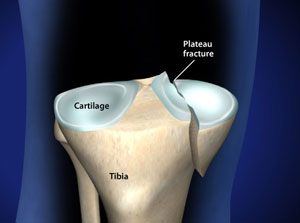 Tibial Plateau Fracture - Willis Knighton Health - Shreveport - Bossier ...