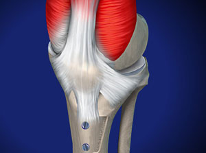 Tibial Tubercle Osteotomy - Willis Knighton Health - Shreveport ...