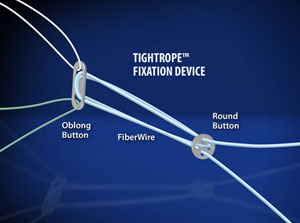 TightRope Fixation for Ankle Syndesmosis - Willis Knighton Health ...