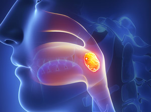 Tonsil Stones (Tonsilloliths) - Willis Knighton Health - Shreveport ...