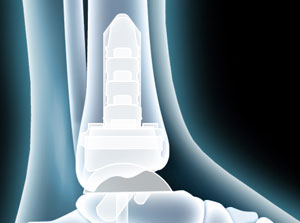 Total Ankle Joint Replacement (Wright INBONE® II) - Willis Knighton ...