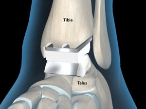 Total Ankle Joint Replacement (STAR Mobile-Bearing) - Willis Knighton ...