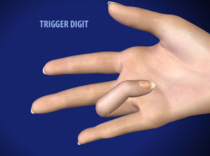 Trigger Digit - Willis Knighton Health - Shreveport - Bossier City ...