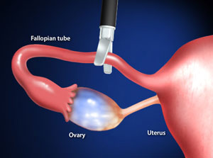 Tubal Ligation (Laparoscopic Bipolar Tubal Coagulation) - Willis ...