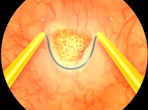 Transurethral Resection of Bladder Tumor (TUR or TURBT) - Willis ...