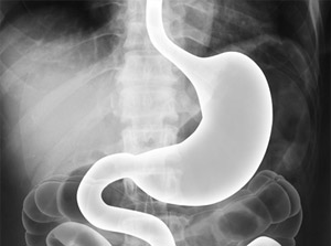 Upper Gastrointestinal Series (UGI) - Willis Knighton Health ...